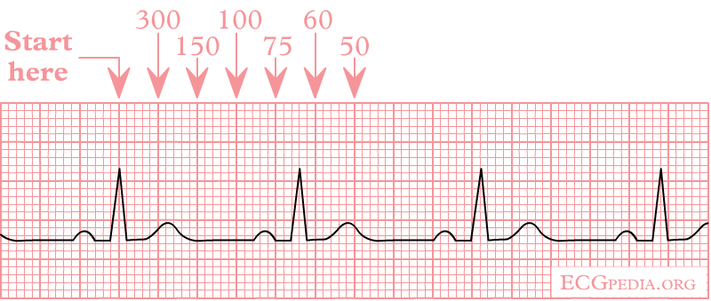 EKG Interpretation for Nurses | NURSING.com
