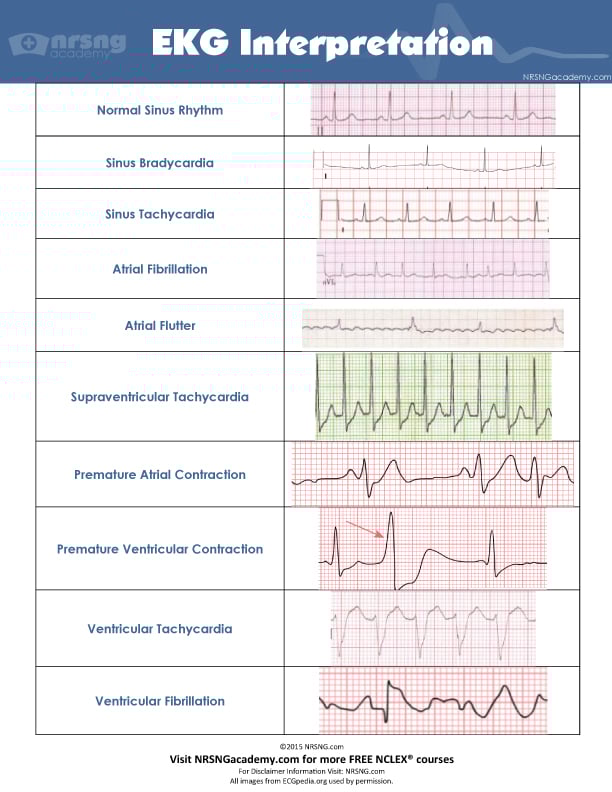EKG Interpretation for Nurses | NURSING.com