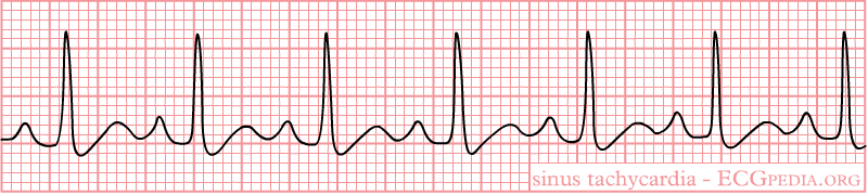 EKG Interpretation for Nurses | NURSING.com