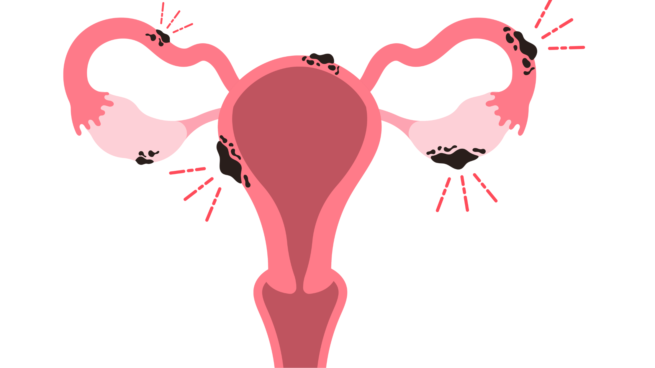 You'll Need to Know This about Pelvic Inflammatory Disease (PID) for ...